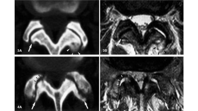 Imaging of lumbar spondylosis | PPTX