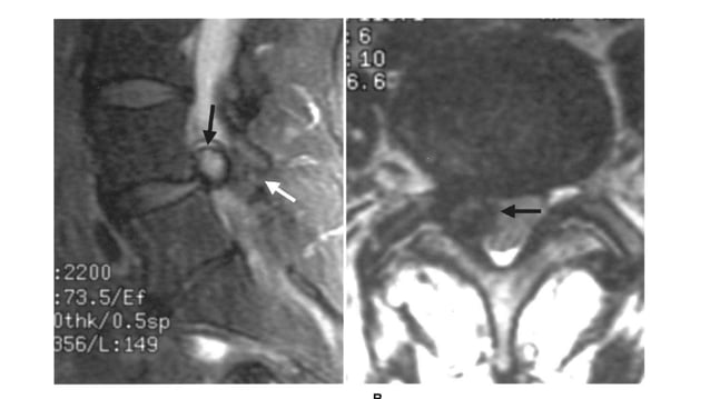 Imaging of lumbar spondylosis | PPTX