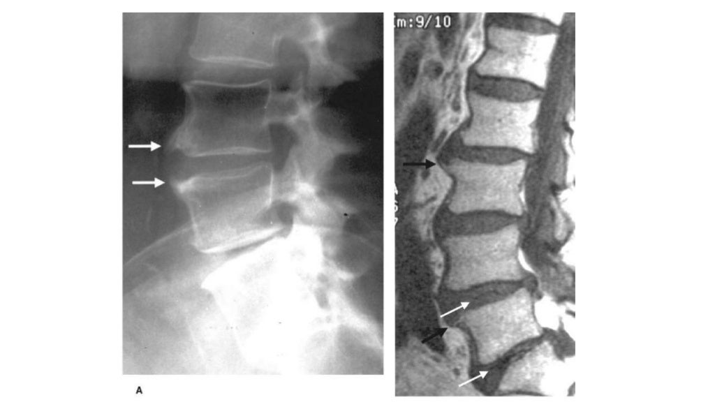 Imaging of lumbar spondylosis