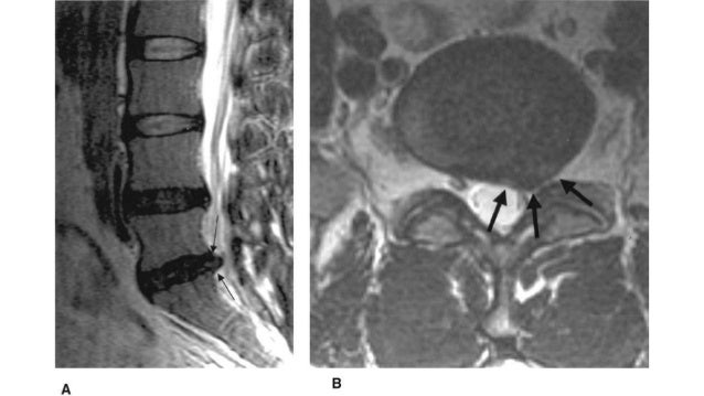 Imaging of lumbar spondylosis