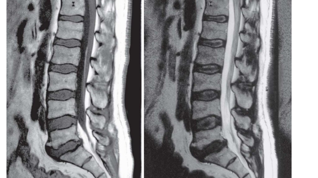 Imaging of lumbar spondylosis