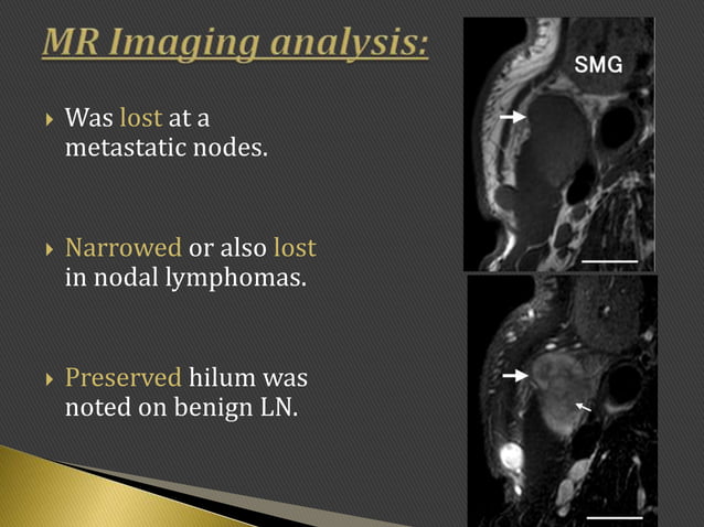 Imaging of enlarged lymph node