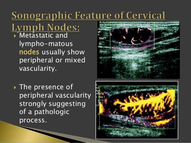 Imaging of enlarged lymph node