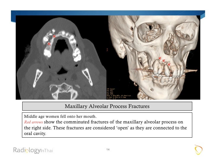 Imaging Of Facial Trauma Part 3 (2) 2
