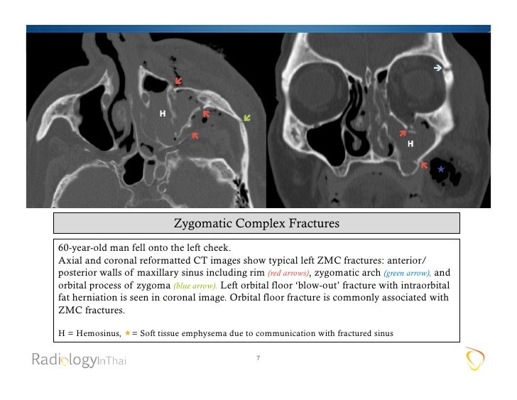 Zygomatic Maxillary Complex Fracture