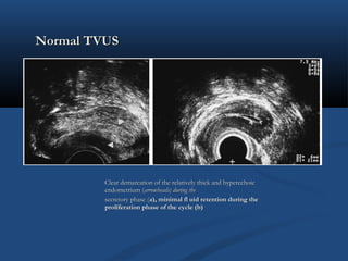 role of Imaging in female infertility | PPT