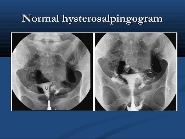 role of Imaging in female infertility