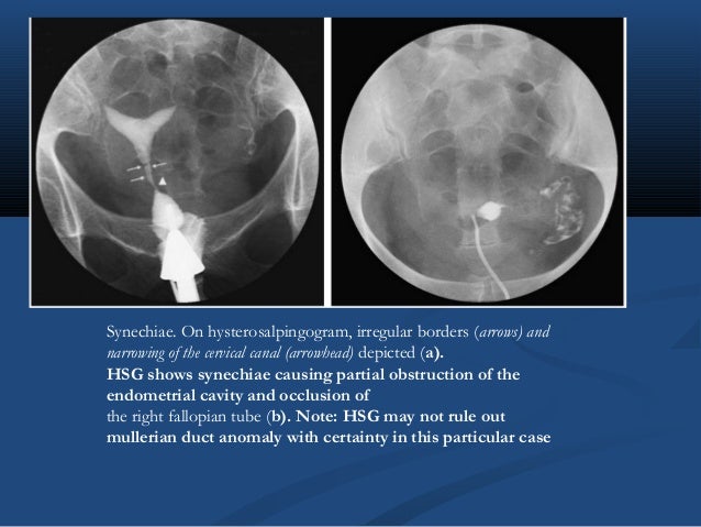 role of Imaging in female infertility