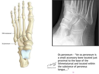 Imaging of foot in non trauma and non neoplastic diseases | PPT