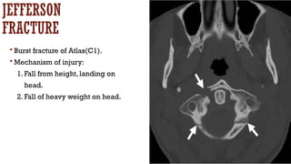Imaging of fractures on Xray, CT and MRI.pptx