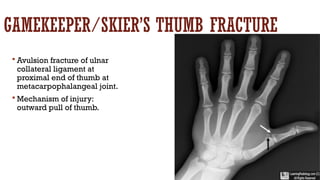 Imaging of fractures on Xray, CT and MRI.pptx