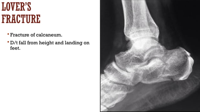 Imaging of fractures on Xray, CT and MRI.pptx