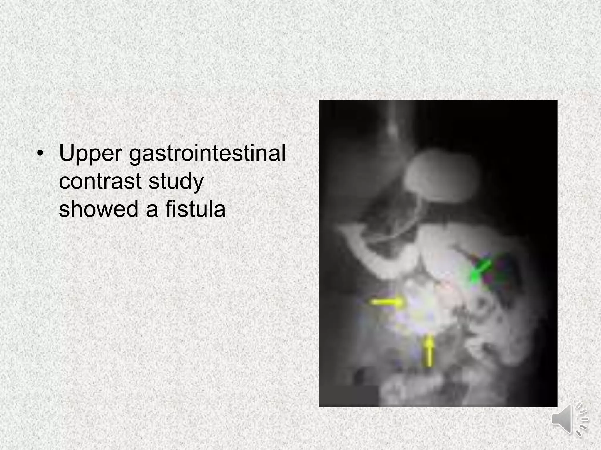 Imaging of gossybioma (retained missed towel surgical spongs) Dr Ahmed ...