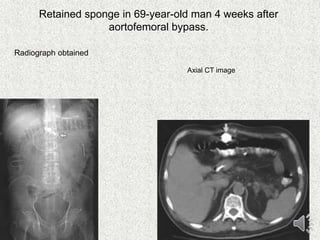 Imaging of gossybioma (retained missed towel surgical spongs) Dr Ahmed ...