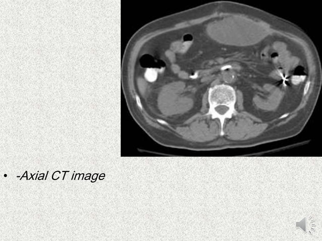 Imaging of gossybioma (retained missed towel surgical spongs) Dr Ahmed ...