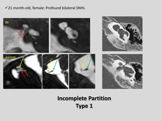 Imaging of hearing loss ESHNR 2019 cinisi | PPTX