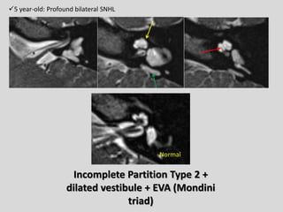 Imaging of hearing loss ESHNR 2019 cinisi | PPTX