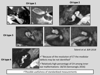 Imaging of hearing loss ESHNR 2019 cinisi | PPTX
