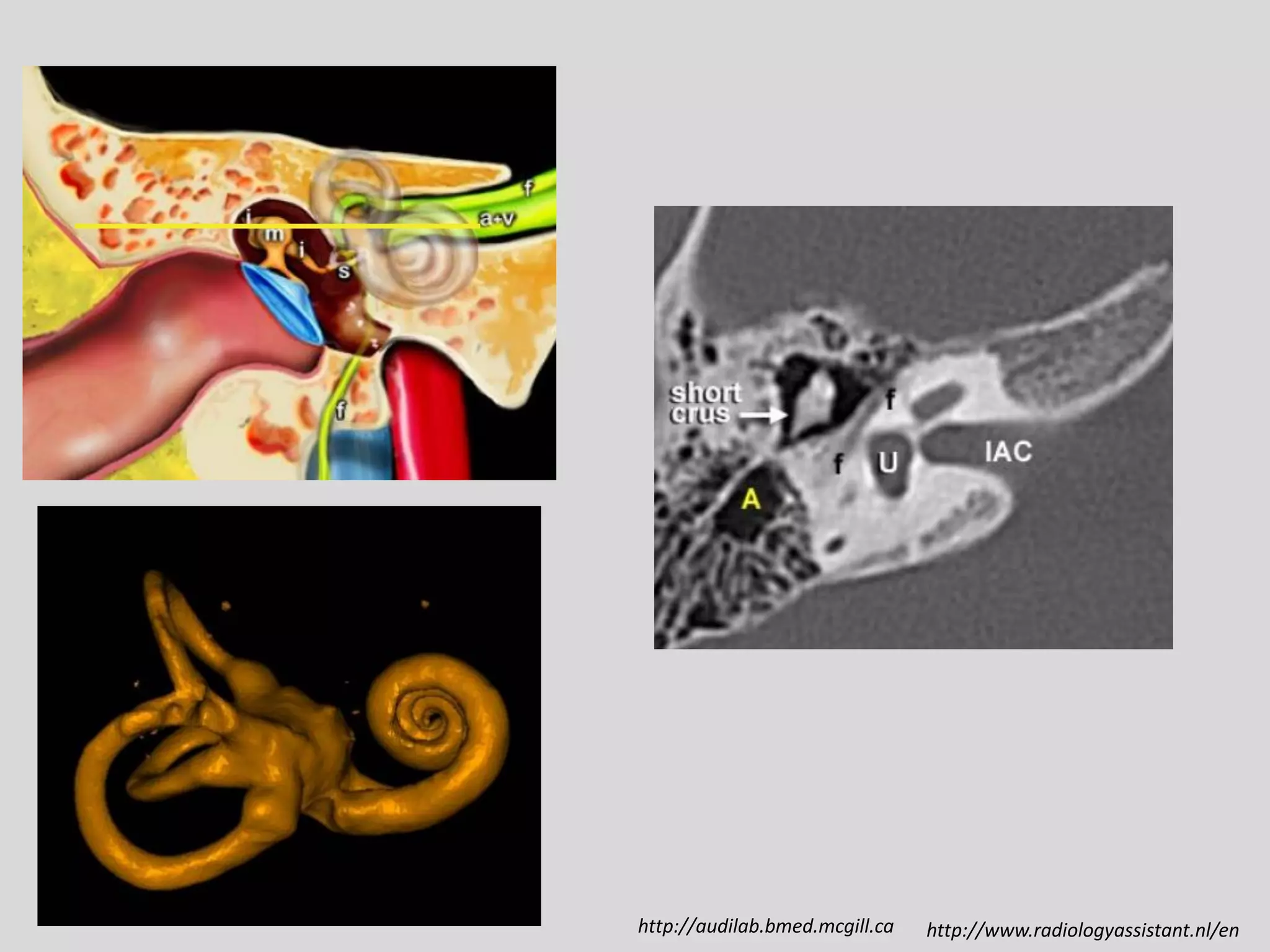 Imaging of hearing loss: Sensorineural hearing loss | PDF