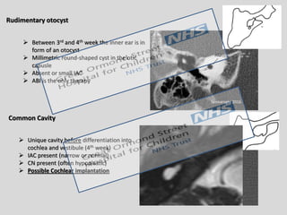 Imaging of hearing loss: Sensorineural hearing loss | PDF
