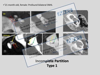 Imaging of hearing loss: Sensorineural hearing loss | PDF