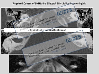 Imaging of hearing loss: Sensorineural hearing loss | PDF