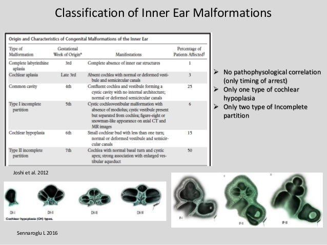 Imaging of hearing loss: Sensorineural hearing loss