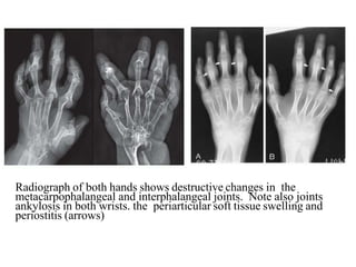 Imaging of inflammatory arthritis ppt | PPTX