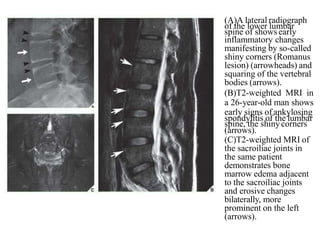 Imaging of inflammatory arthritis ppt | PPTX