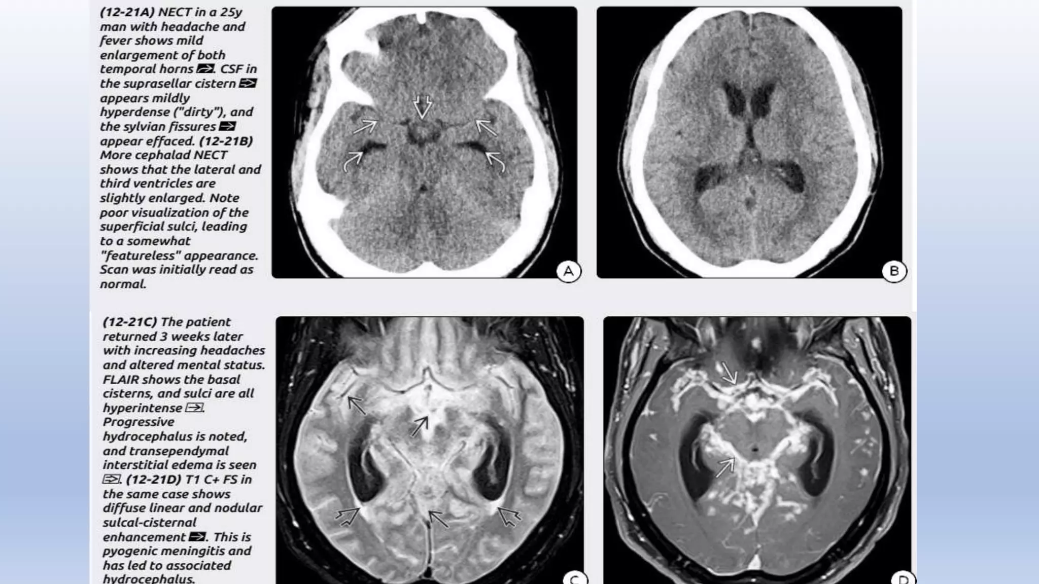 Imaging of intracranial infections including COVID 19 pk2 ppt, pdf | PPTX