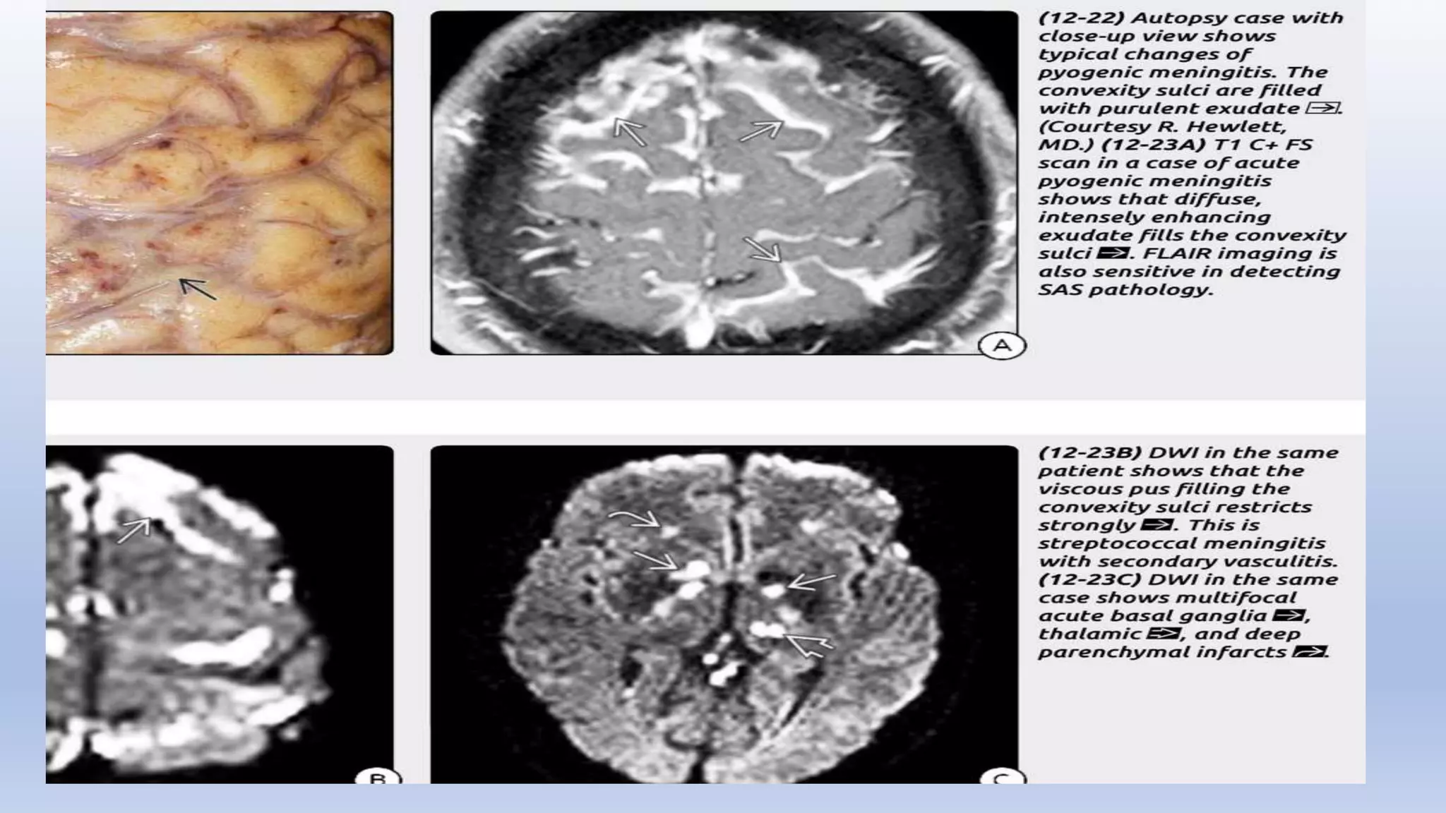 Imaging of intracranial infections including COVID 19 pk2 ppt, pdf | PPTX