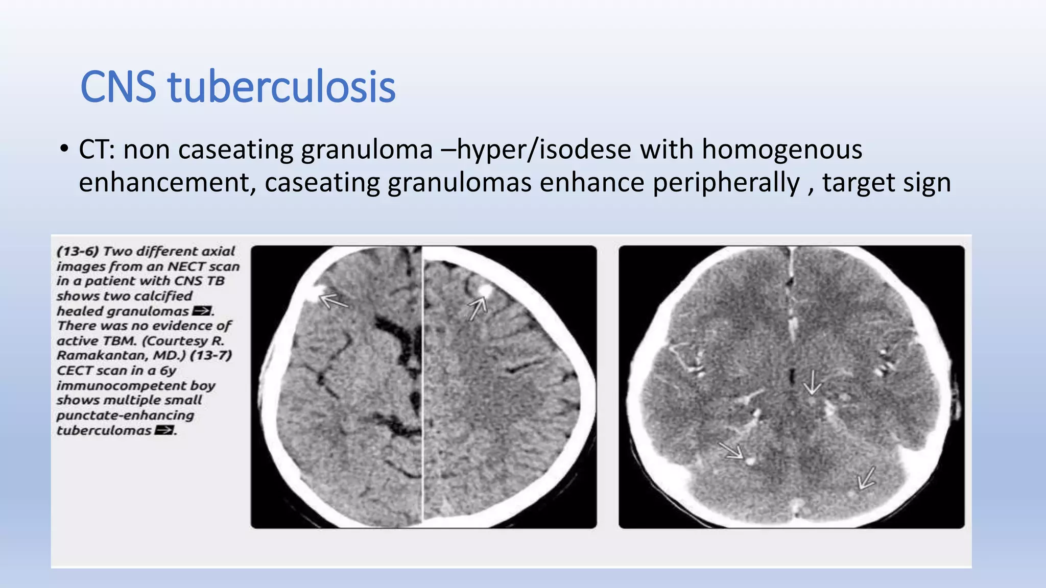 Imaging of intracranial infections including COVID 19 pk2 ppt, pdf | PPTX