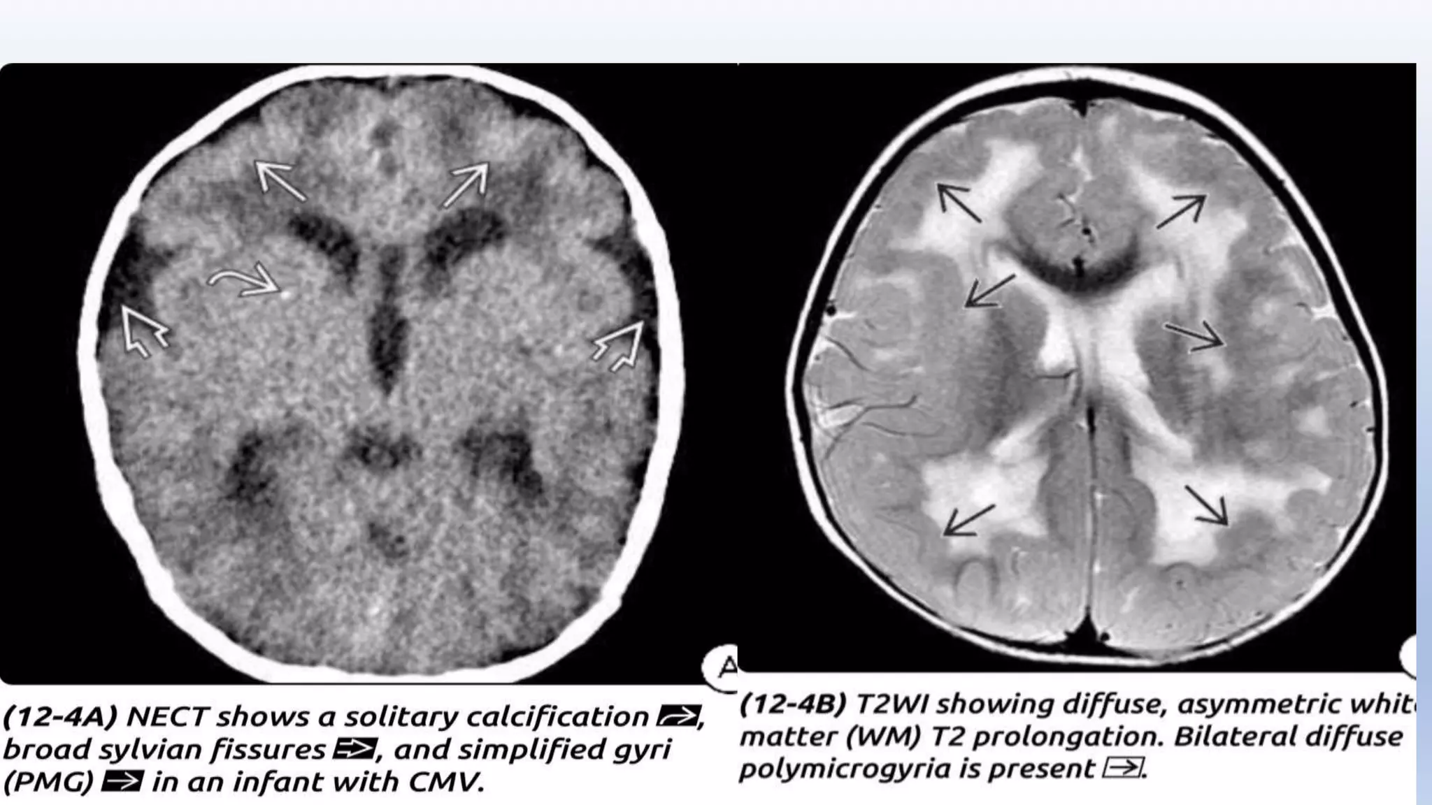 Imaging of intracranial infections including COVID 19 pk2 ppt, pdf | PPTX