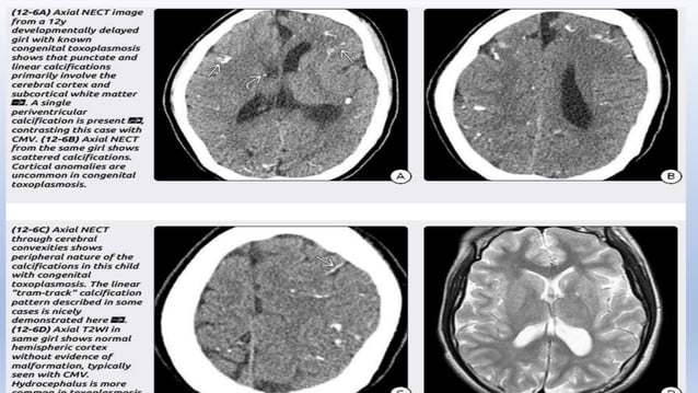 Imaging of intracranial infections including COVID 19 pk2 ppt, pdf | PPT