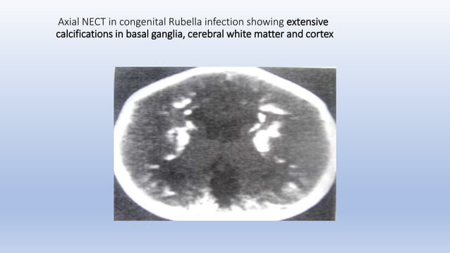 Imaging of intracranial infections including COVID 19 pk2 ppt, pdf | PPT
