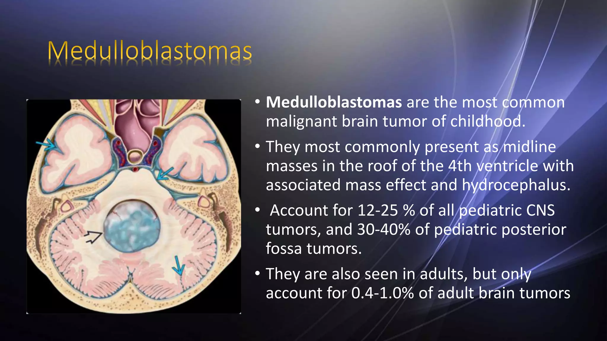 IMAGING OF INTRAVENTRICULAR TUMORS | PPTX