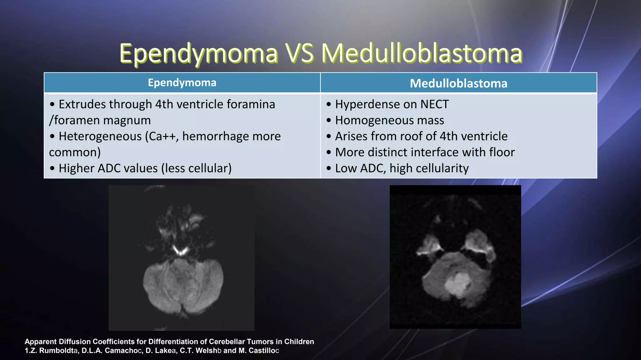 IMAGING OF INTRAVENTRICULAR TUMORS | PPTX