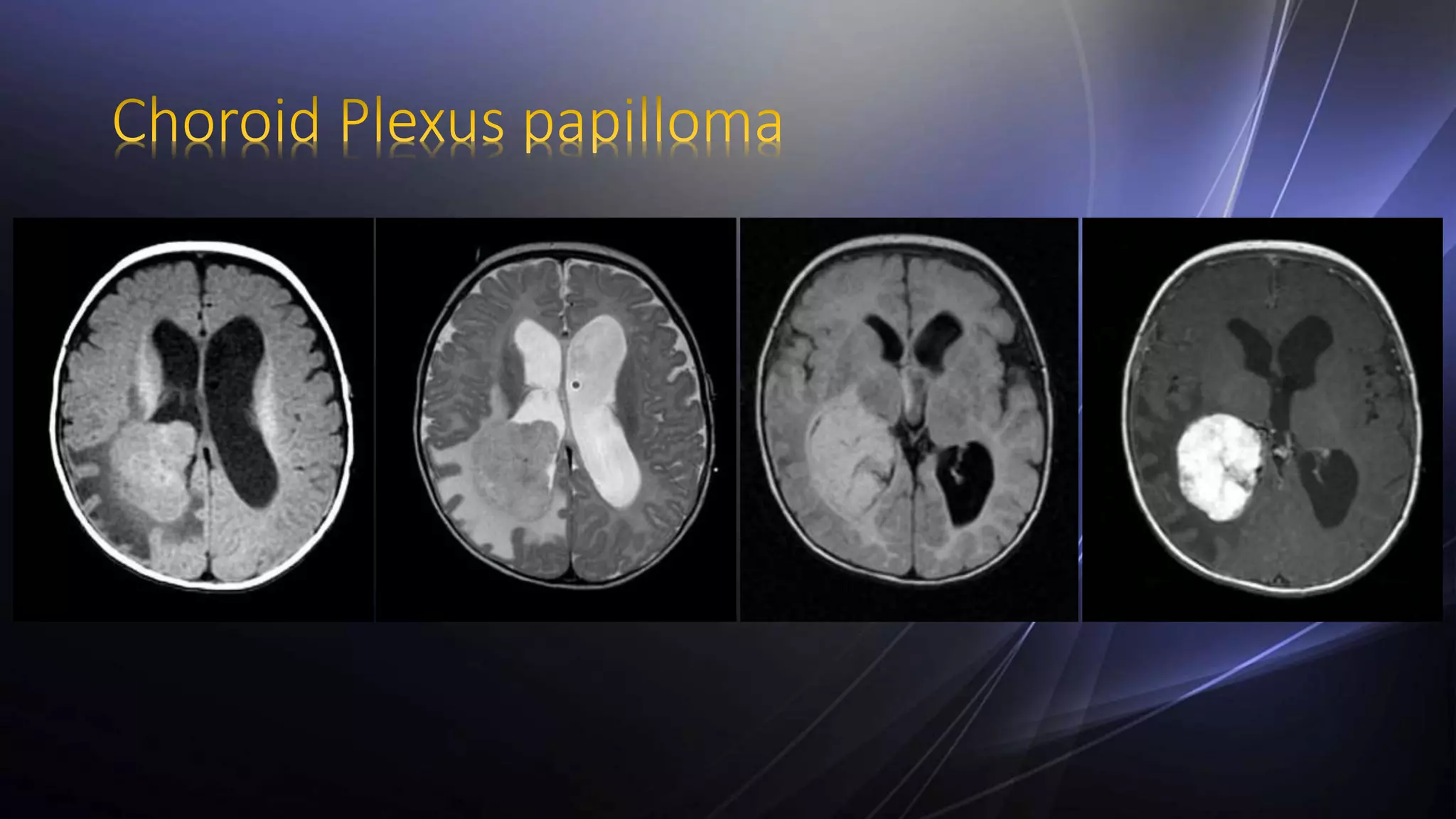 IMAGING OF INTRAVENTRICULAR TUMORS | PPTX