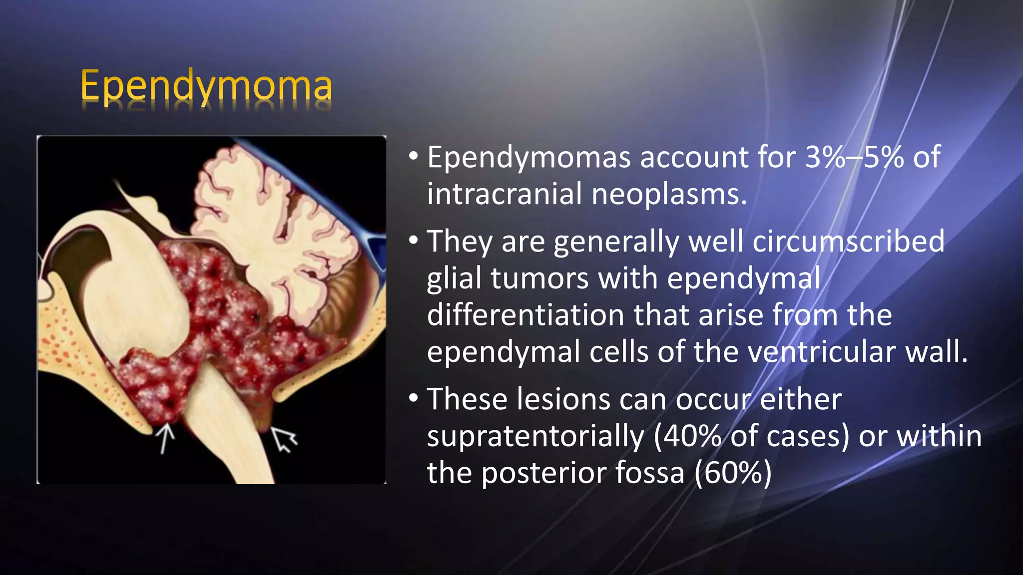 IMAGING OF INTRAVENTRICULAR TUMORS | PPTX