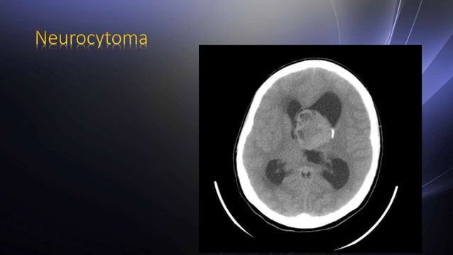 IMAGING OF INTRAVENTRICULAR TUMORS | PPTX
