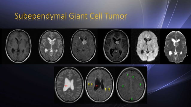 IMAGING OF INTRAVENTRICULAR TUMORS | PPTX