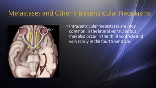 IMAGING OF INTRAVENTRICULAR TUMORS | PPTX