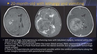 IMAGING OF INTRAVENTRICULAR TUMORS | PPTX