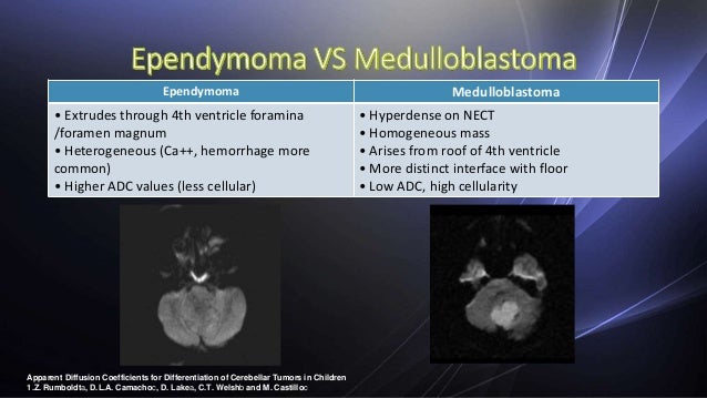 IMAGING OF INTRAVENTRICULAR TUMORS