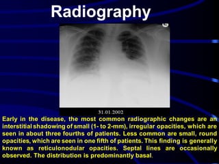 Imaging of IPF | PPT