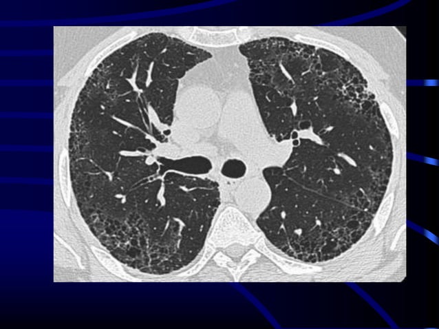 Imaging of IPF | PPT