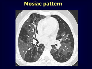 Imaging of IPF | PPT