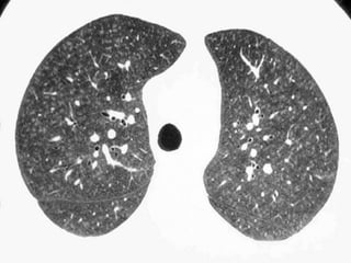 Imaging of IPF | PPT