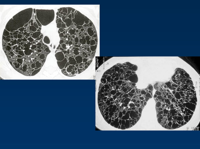Imaging of IPF | PPT