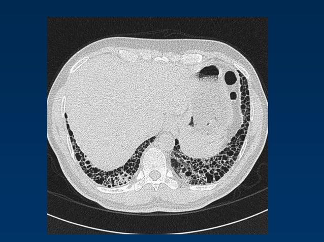 Imaging of IPF | PPT